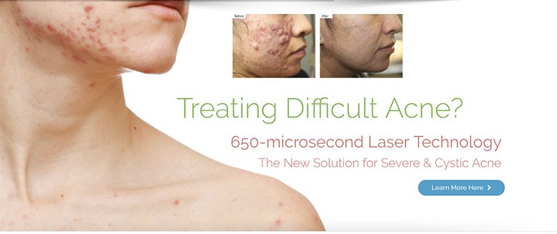 acne-banner - Beauty Wire Magazine